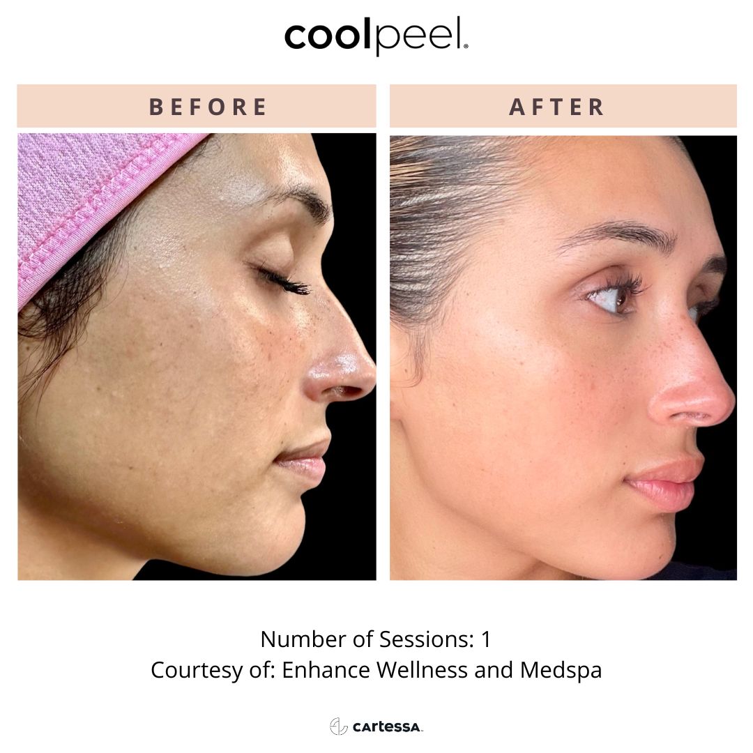 Cartessa Tetra Pro CoolPeel & Deka CO2 Laser Treatments – Elite ...