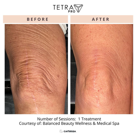 Cartessa Tetra Pro CoolPeel & Deka CO2 Laser Treatments – Elite ...